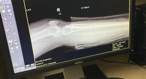 One Week Post Op Tib Fib R Orif