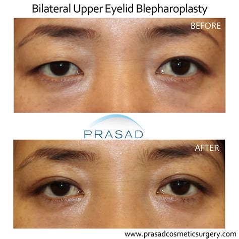 Double Eyelid Surgery Before And After Photos Dr Amiya Prasad