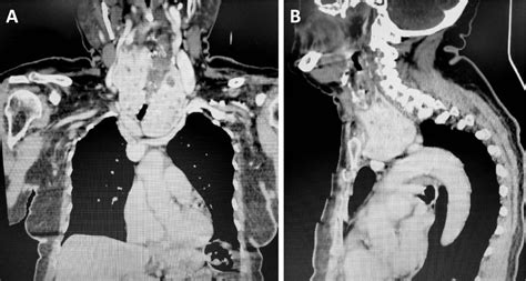 Ectopic Thyroid In The Anterior Mediastinum Resected Through A Video Assisted Transcervical