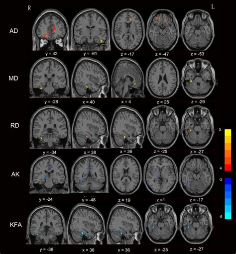 Comparison Of Diffusion And Kurtosis Metrics Between NMHE Patients With