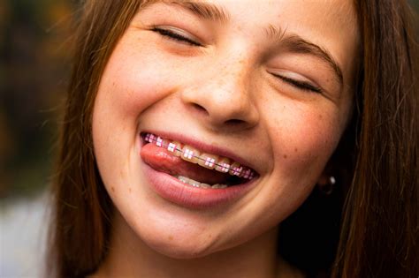 Lightforce Braces Local Orthodontics Top Orthodontist In Johnson City Tn