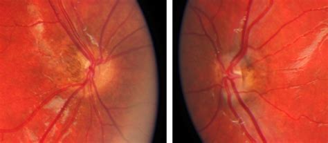 Optic Nerve Hypoplasia