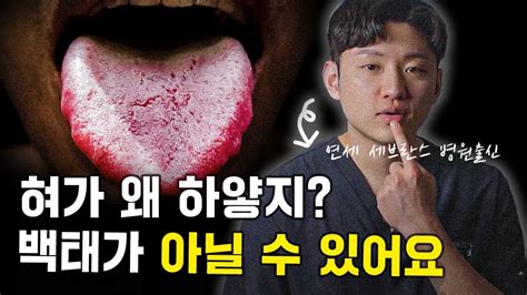 당신만 몰랐던 혀에 백태가 생기는 원인 백태를 없애는 방법 Youtube