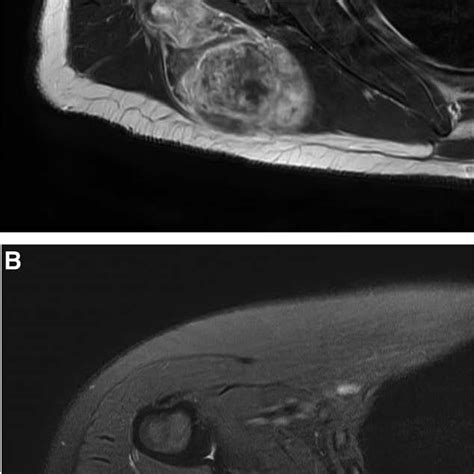 Microscopic Appearance Of Vulvar Myxoid Liposarcoma Tumor Mass With Download Scientific