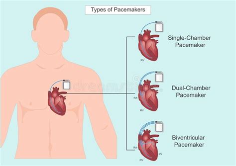 The Different Types Of Pacemakers Stock Illustration Illustration Of