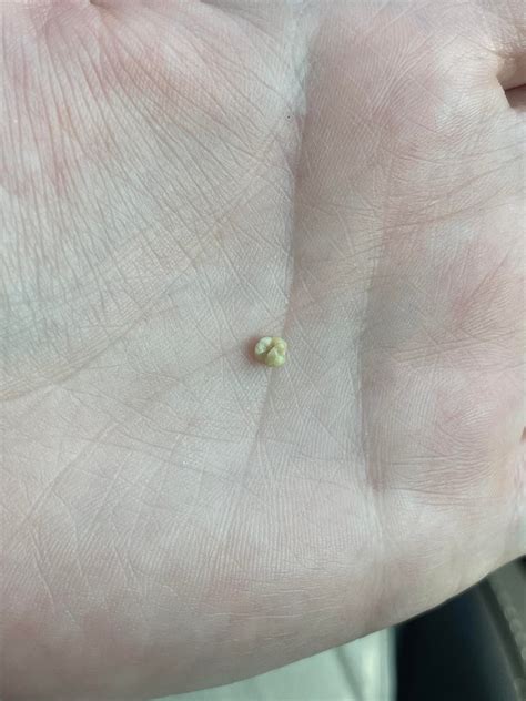 So What Is This Only On One Side Of My Tonsil And Only Pain On That