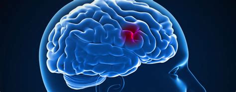 Terapi Trombolitik Untuk Stroke Iskemik Mandaya Hospital Group