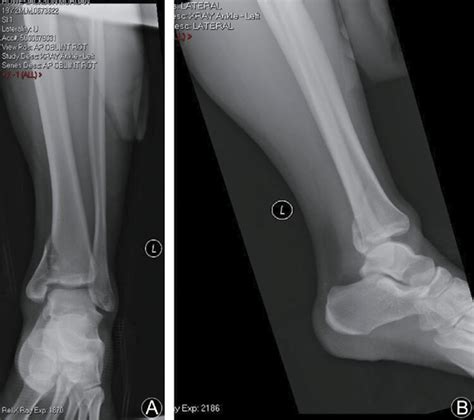 Dislocation Of The Proximal And Distal Tibiofibular 46 Off