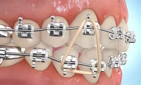 Elastics Instructions Yang Orthodontics