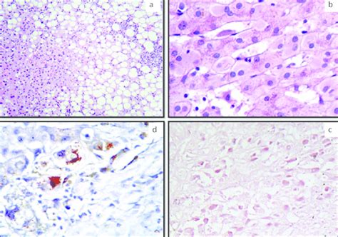 Ignored Areas In The Current Scoring System A Macrovesicular