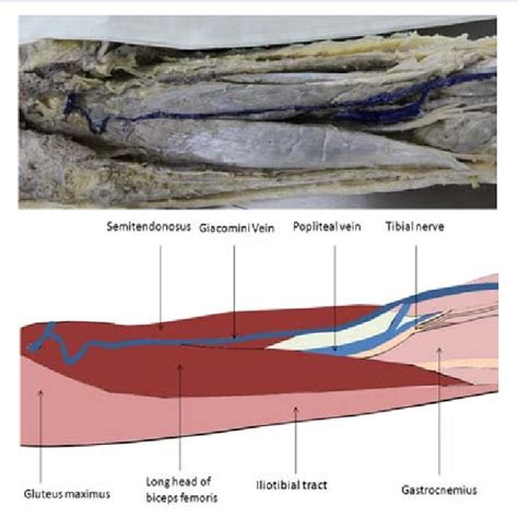 Unusual Origin Of Brachiocephalic Trunk Download Scientific Diagram