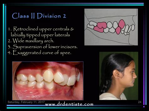 Classification Of Malocclusion Ppt