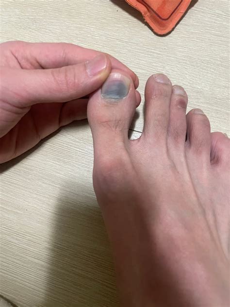 엄지발톱 멍 질문 지식in