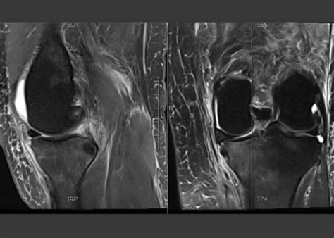 Medial Meniscus Tear Knee Specialist Minnesota