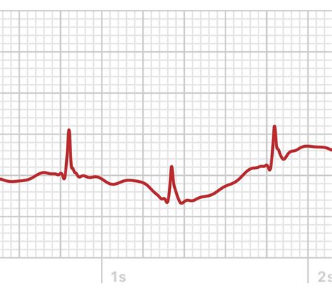 Sinus Tach For Last 30 Minutes Rreadmyecg