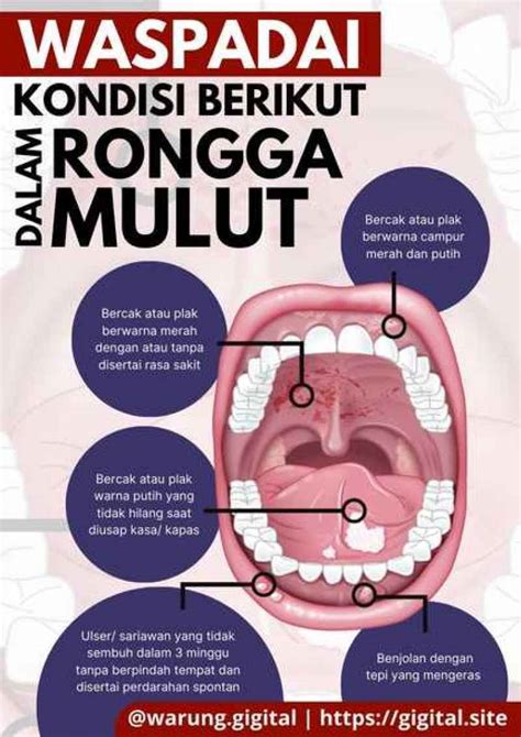 Jual Poster Edukasi Waspadai Kondisi Kanker Rongga Mulut Di Seller