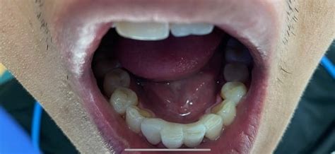 What Is The Maryland Dental Bridge Procedure Glenhuntly Dental Clinic