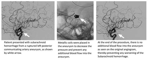 Cerebral Aneurysm Mecklenburg Radiology Associates