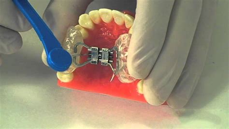 El Disyuntor De Paladar Y Sus Usos Para Tu Salud Dental Dentista En