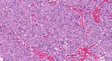 Neuroendocrine Tumour Pathology Dictionary Mypathologyreportca