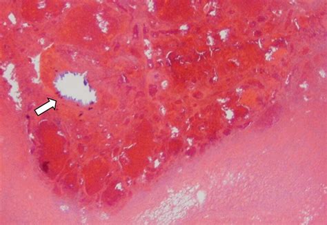 Paediatric Torsed Extralobar Sequestration Containing Calcification Imaging Findings With