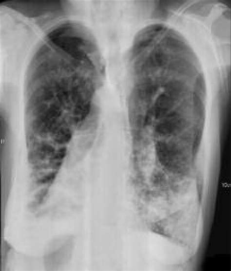 Chest X Ray Revealed Dextrocardia Bilateral Bronchiectasis Download Scientific Diagram
