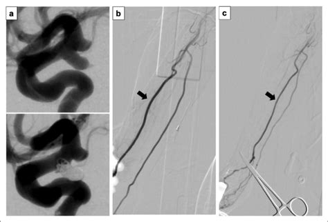 A 73 Year Old Woman Underwent Coil Embolization With Stent Assisted Download Scientific Diagram