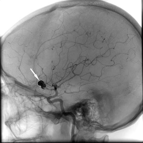 Sagittal Planar Cerebral Dsa Following Coiling The Arrow Identifies Download Scientific