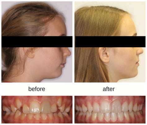 Albums 101 Pictures Jaw Surgery Overbite Before And After Pictures Latest