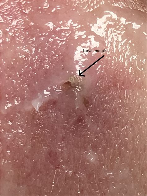 A Rare Encounter Locally Acquired Furuncular Myiasis Botfly In Ohio