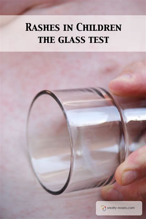 Blanching And Non Blanching Rashes Snotty Noses