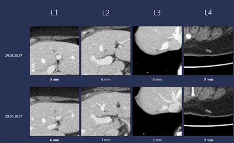 Time Savings Using The Sectra Lesion Tracking Tool Sectra Medical