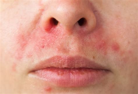Eczema Dermatitis Around Nose At Abigail Cropper Blog