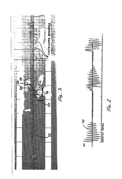 Airway Obstruction Patented Technology Retrieval Search Results Eureka Patsnap