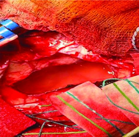Postoperative Cyst After Marsupialization Download Scientific Diagram
