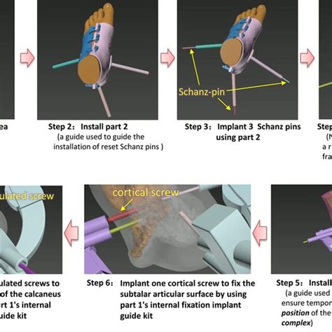 Box Diagrams Of Böhler Angle Gissane Angle Subtalar Joint Width And