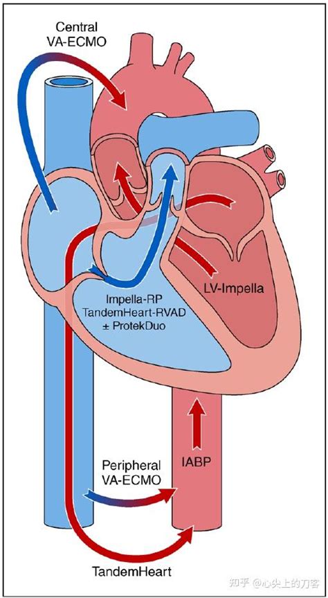 Impella、iabp、va Ecmo和tandemheart——美国心脏学会科学声明 知乎