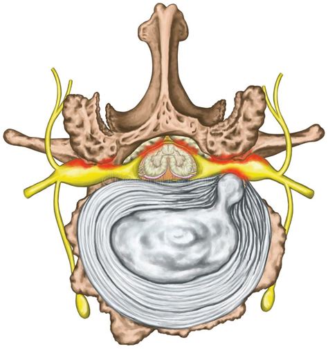 Lumbar Disc Herniation Genetic At Anthony Blubaugh Blog