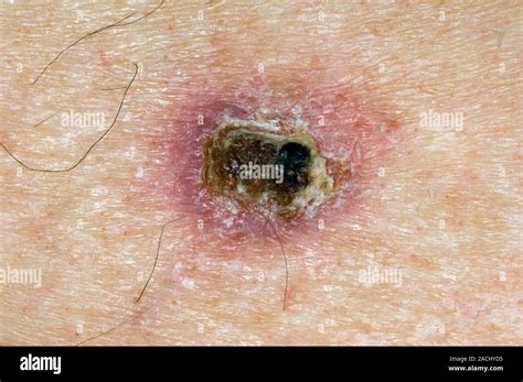 Close Up Of Skin Cancer Basal Cell Carcinoma On The Shoulder In A 73
