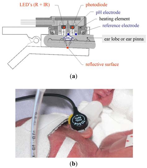 Blood Gas Monitoring Transcutaneous Carbon Dioxide Partial Pressure Determination