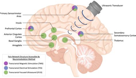 Transcranial Focused Ultrasound Tfus A Promising Noninvasive Deep Brain Stimulation Approach