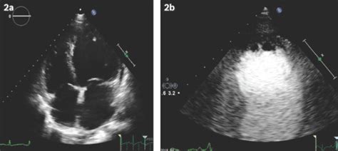 A Review Of The Safety And Clinical Utility Of Contrast Echocardiography PMC
