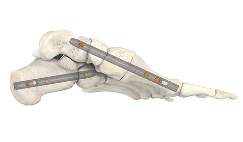Navicular Cuneiform Arthrodesis Stryker