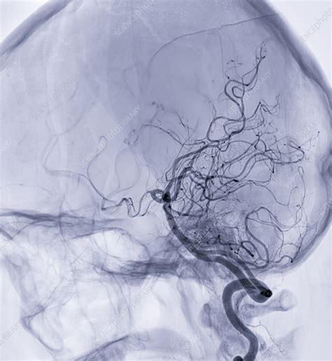 Cerebral Arteries Angiogram Stock Image F037 7049 Science Photo Library