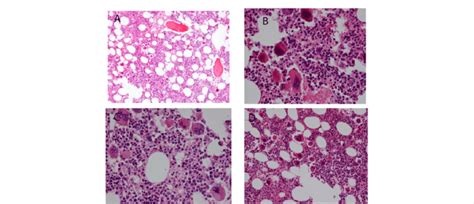 Clinical Case Of Jak2 Mpl Negative And Calcireticulin Calr Mutated Et Download Scientific