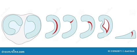 Meniscus Tears Of The Knee Joint Anatomy Injury Labeled Illustration