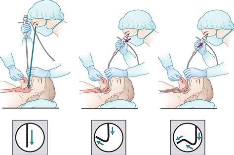 Flexible Scope Intubation Techniques Clinical Tree