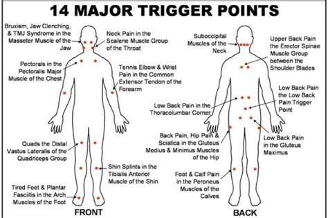 Trigger Points Are Areas Of Muscle Tissue That Become Knotted And