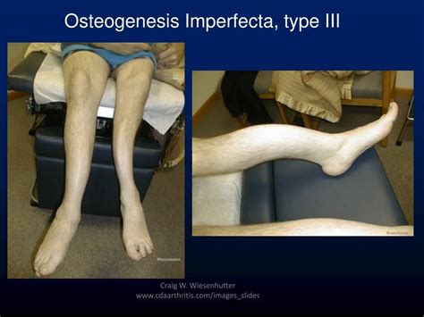 Ppt Understanding Genetic Collagen Disorders And Osteogenesis