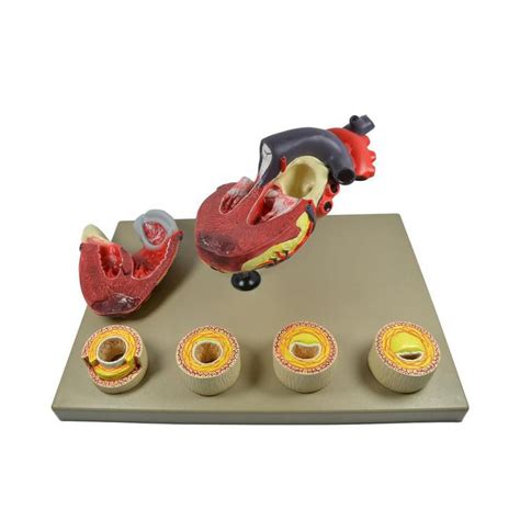 Heart Pathologies And Conditions